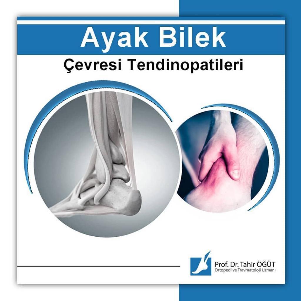Plantar Fasiit Nedir?